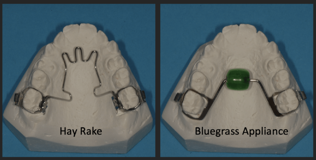 Thumb sucking … the orthodontist’s nemesis! - Patient Site